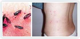 Pest Controllers | Human Flea Control